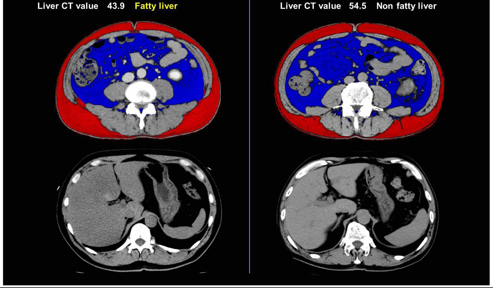 The Challenge of Diagnosing NASH – NASH AWARE